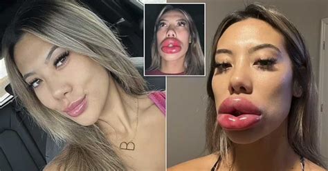 Woman Goes Viral Over Massively Swollen Lips Caused By Discount Lip
