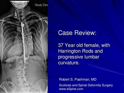 Case Review 28 Patient With Lumbar Scoliosis Status Post Surgery W