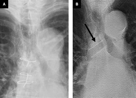 Optimizing Monitoring Of Pulmonary Airway Interventions With Digital Tomosynthesis Applied