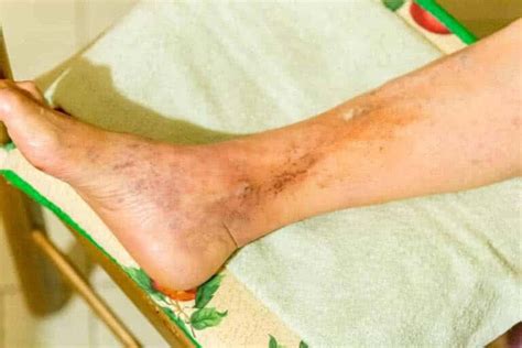 Flebite O Que é Sintomas Tratamentos E Riscos Para A Saúde