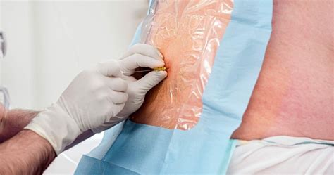 Nerve Block Pros And Cons Visp