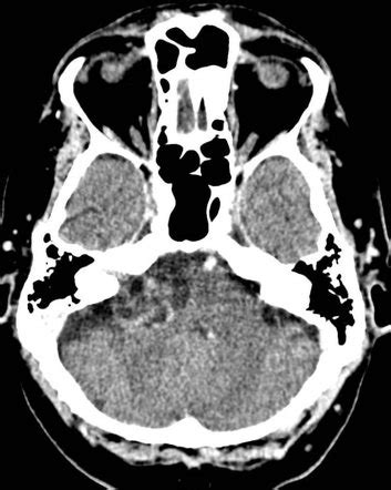Schwannoma Mri Features