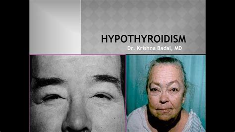 Hypothyroidism Myxedema Youtube