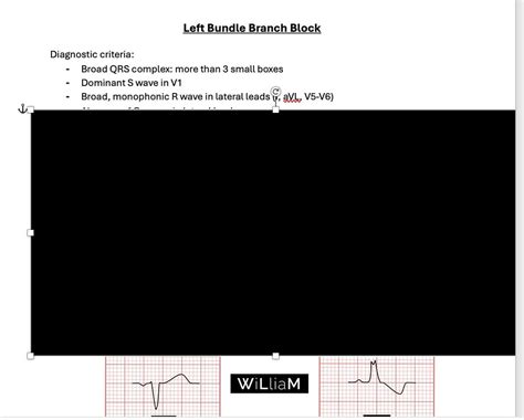 Lbbb And Rbbb Ecg Quick Notes Etsy