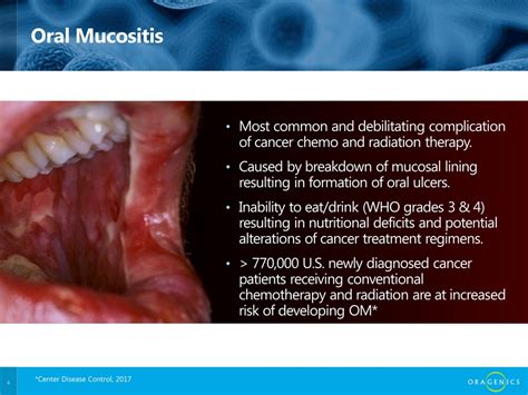 Radiation Mucositis Ppt At Greg Howell Blog