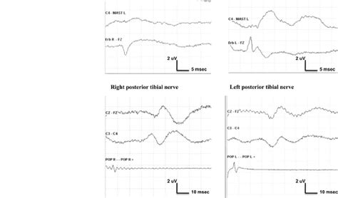 Sudden Loss Of Right Median Nerve Peripheral And Cortical Sep Responses