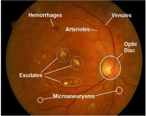 A Hybrid Approach For Diagnosing Diabetic Retinopathy From Fundus Image