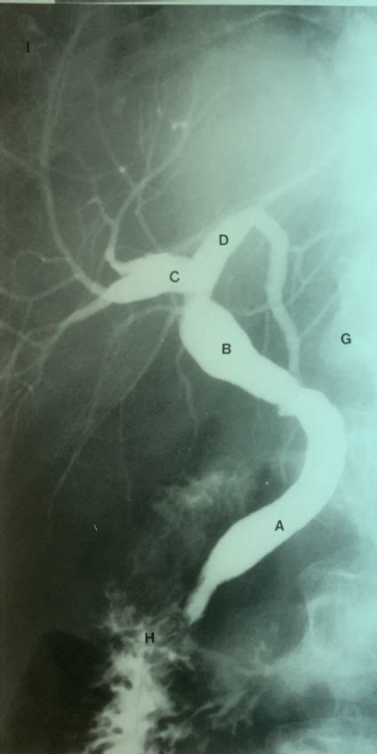 Diagram Of 10 8 Cholangiogram Cholecystectomy Quizlet