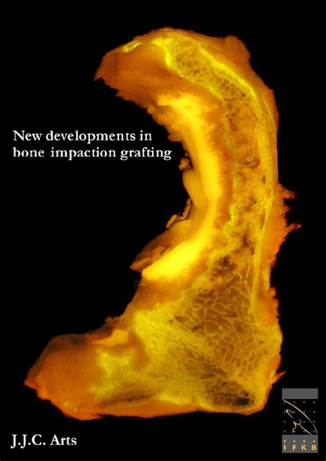 Pdf New Developments In Bone Impaction Grafting
