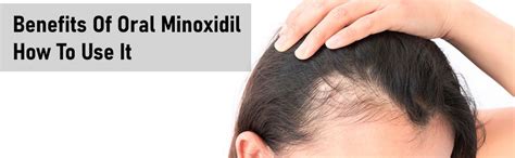 Benefits Of Oral Minoxidil And How To Use It Okdermo