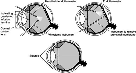 Accesslange General Ophthalmology Chapter 9 Vitreous Page 1