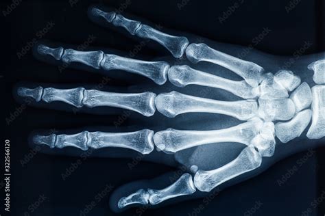 Human Adult Female Right Hand Bones X Ray Image Medical And Anatomy