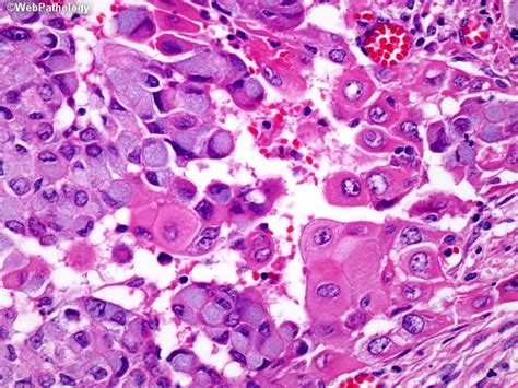 Adenosquamous Carcinoma
