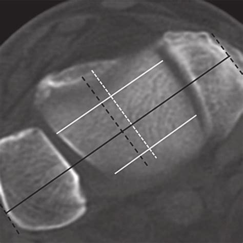 Pdf Effects Of Tibial Torsion On Distal Alignment Of Extramedullary Instrumentation In Total