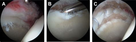 Cartilage Lesions Of The Hip Clinics In Sports Medicine