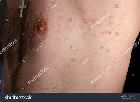Pityriasis Rosea Type Skin Rash ภาพสต็อก 1951221667 Shutterstock