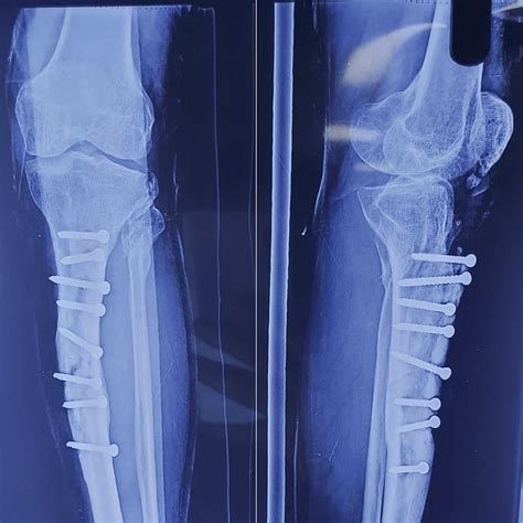 Phyllodes Tumor Of Right Breast Rmedicalgore