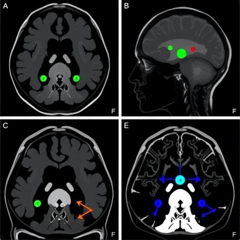Ai Model Advances Imaging Detection Of Extranodal Extension And Predicts Bioengineer Org
