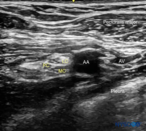 Regional Anesthesia Ultrasound View Of The Brachial Plexus At The Costoclavicular Space Nysora