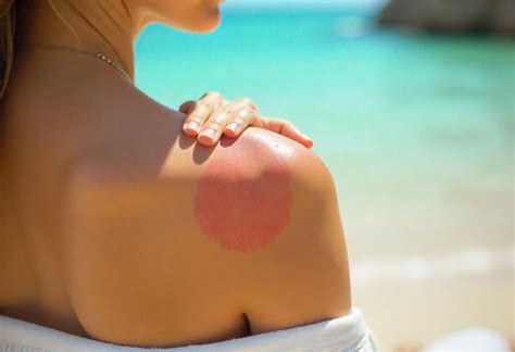 Sunburn Treatment Best Ways To Soothe Skin Fast Rakiza