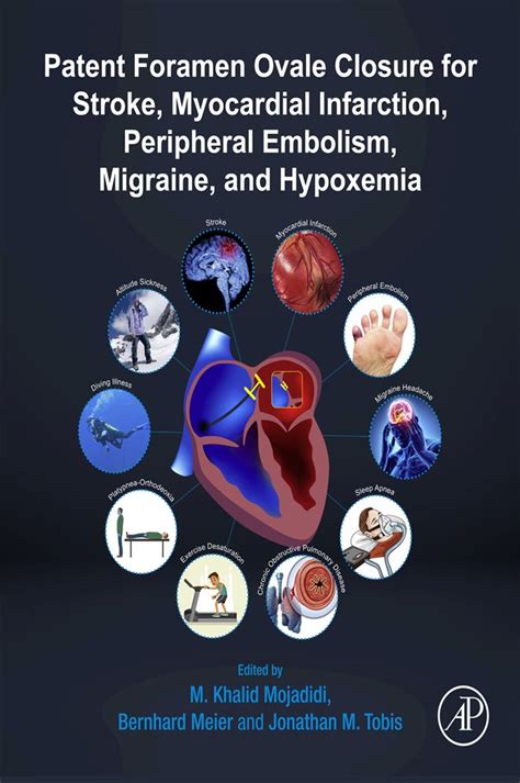 Patent Foramen Ovale Closure For Stroke Myocardial Infarction Peripheral Embolism Migraine