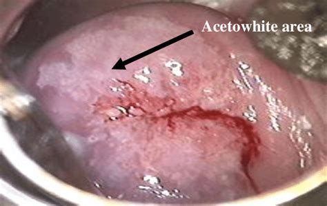 Bleeding Cervical Ectropion Cervical Ectropion Happens When Cells From