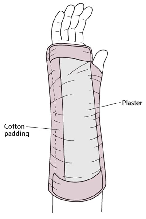 Image Volar Splint Merck Manual Consumer Version