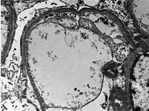 Case 2 Electron Microscopy Glomerulus Image Download Scientific Diagram