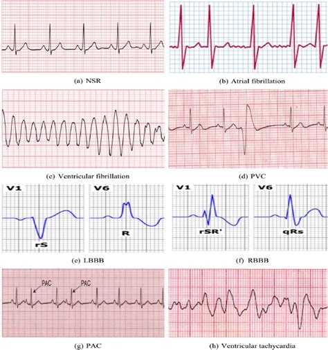 论文审查 Advanced Neural Network Architecture For Enhanced Multi Lead Ecg