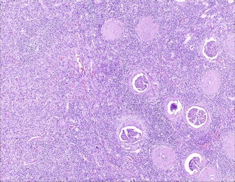 Chronic Pyelonephritis Histology