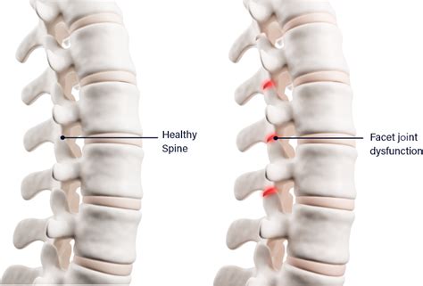 What Is Facet Joint Dysfunction Find Out How To Treat It