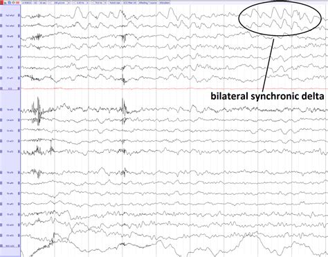 Normal Slowing During Hyperventilation Eegpedia
