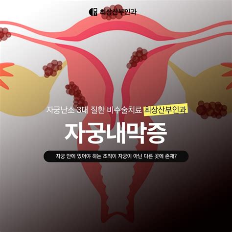 자궁내막증증상 심한 생리통 있을 때