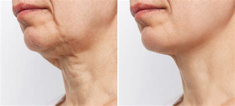 Botox For Jowls Before And After Treatments How It Lifts Costs