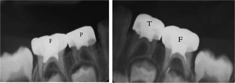 Clinical And Radiographical Evaluation Of Propolis And Thymus Vulgaris Extracts Compared With
