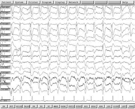 Abnormal Eeg