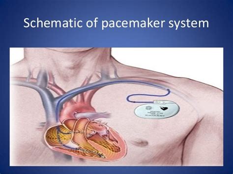 Pacemaker