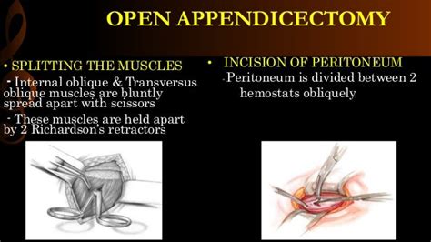 Open Appendicectomy Operative Surgery