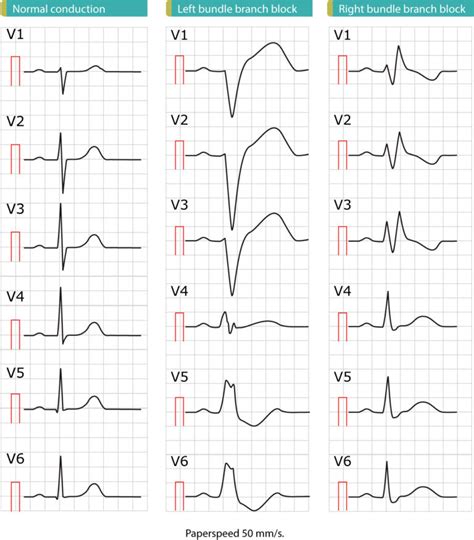 Left Bundle Branch Block Lbbb Ecg Criteria Causes Management The Cardiovascular