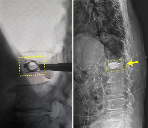 인천 힘찬종합병원 임플란트 이용한 척추 압박 골절 보강술 첫 성공