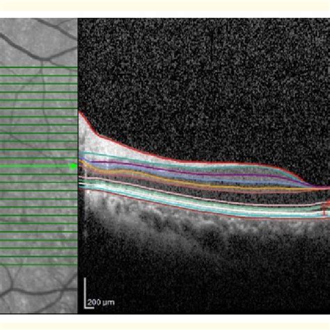 Measurement Of Photoreceptor Outer Segment Length Pros After Download Scientific Diagram