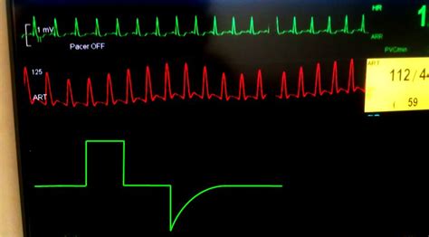 Abnormal Arterial Waveforms