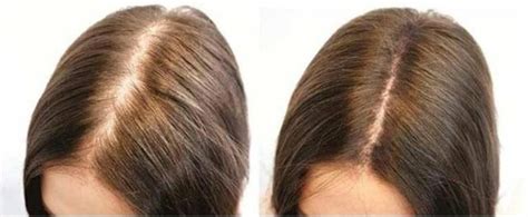 თმის ცვენის საწინააღმდეგო ეს ნიღაბი ძალიან დამეხმარა დღეს ჩემი თმა