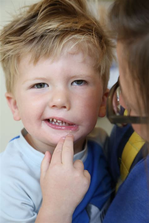 Para Profissionais Médicos Diagnosticando A Síndrome De Moebius Moebius Syndrome Foundation