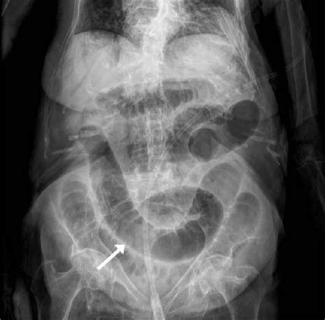 Plain Abdominal X Ray Demonstrating Dilated Loops Of Small Bowel White Download Scientific