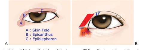 Epicanthic Fold Types