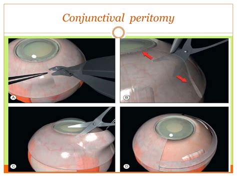 Retinal Detachment Surgery 2pptx