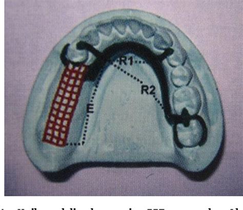Figure From Mandibular Kennedy Class I Partial Denture 47 Off
