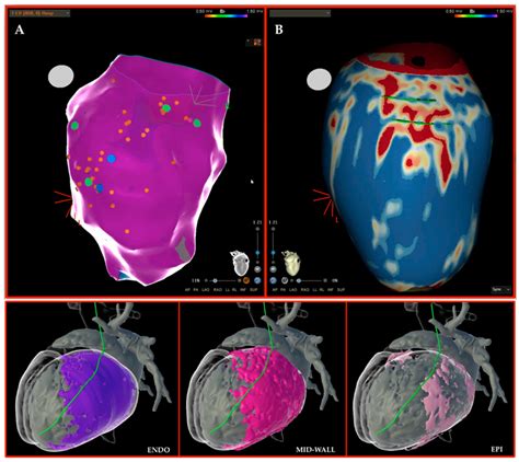 Left Postero Medial Papillary Muscle Pm Pvc Mapping And Ablation Download Scientific Diagram