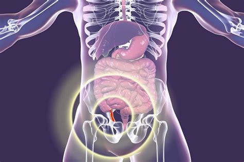 Open Appendectomy Incision